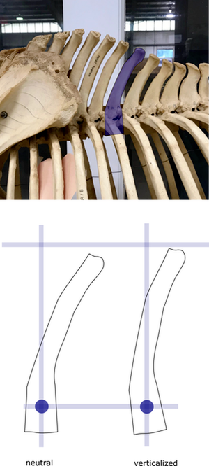 Verticalization of the Thoracolumnbar Spine